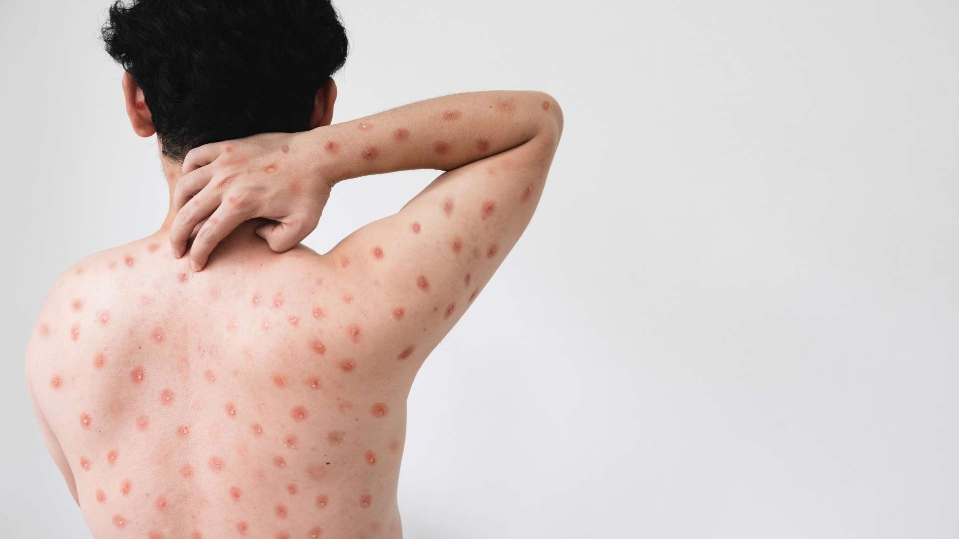 Everything You Need to Know About Monkeypox: Symptoms, Prevention, and ...